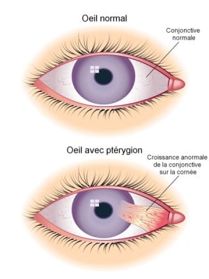 Traitement du ptérygion | eVision centres d’ophtalmologie