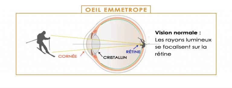 La myopie - eVision Centre ophtalmologie France et Suisse
